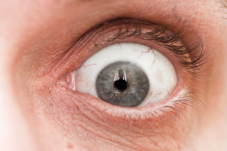 Exoftalmia u ojos saltones - Como Cuidar Los Ojos- Salud visual